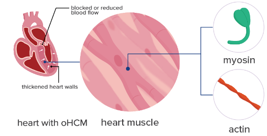 About CAMZYOS® (mavacamten) - Symptomatic Obstructive HCM Treatment