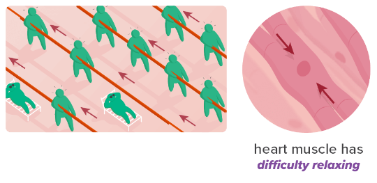 About CAMZYOS® (mavacamten) - Symptomatic Obstructive HCM Treatment